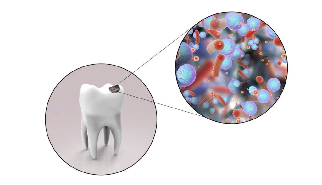 How Does Sugar Affect Your Teeth? - Kaufman Dentistry