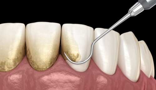 The 5 Steps of the Dental Cleaning Process - Kaufman Dentistry