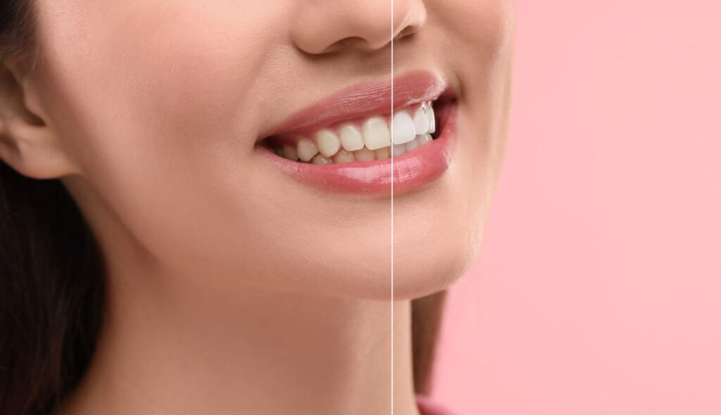 The 5 Steps of the Dental Cleaning Process - Kaufman Dentistry