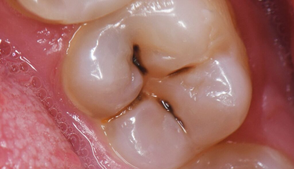 Important Facts About Cavities - Kaufman Dentistry