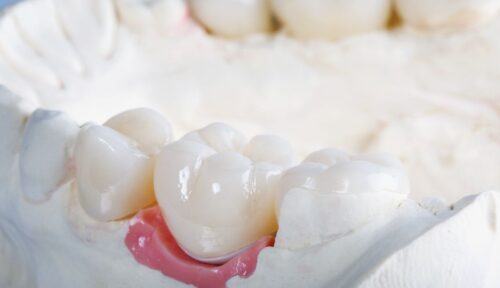 How to Fix Missing Teeth Without Implants - Kaufman Dentistry