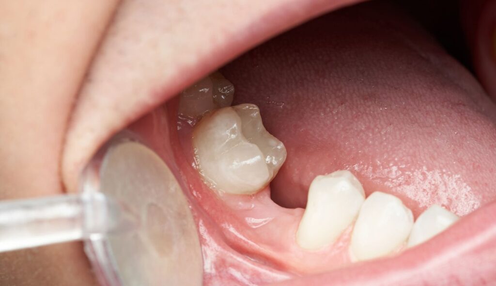 How to Fix Missing Teeth Without Implants - Kaufman Dentistry