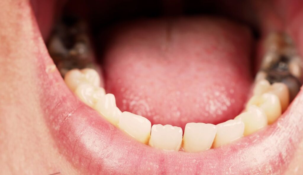 What Are the Symptoms of Tooth Decay? - Kaufman Dentistry