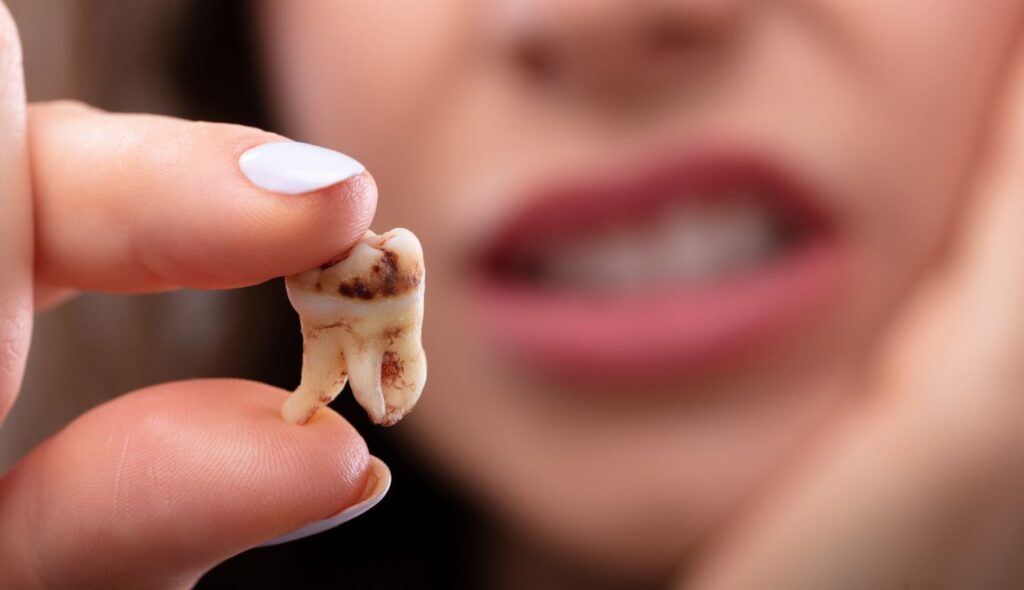 Can You Reverse Tooth Decay? - Kaufman Dentistry